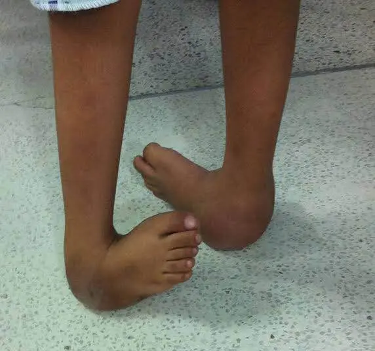 10, 000 Nigerian Babies Born with Clubfoot Annually — PCDF - Latest ...